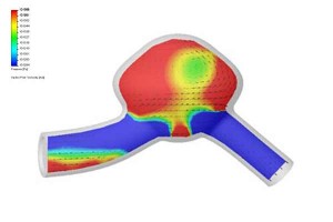 Flow Visualization of Arteries | Flometrics
